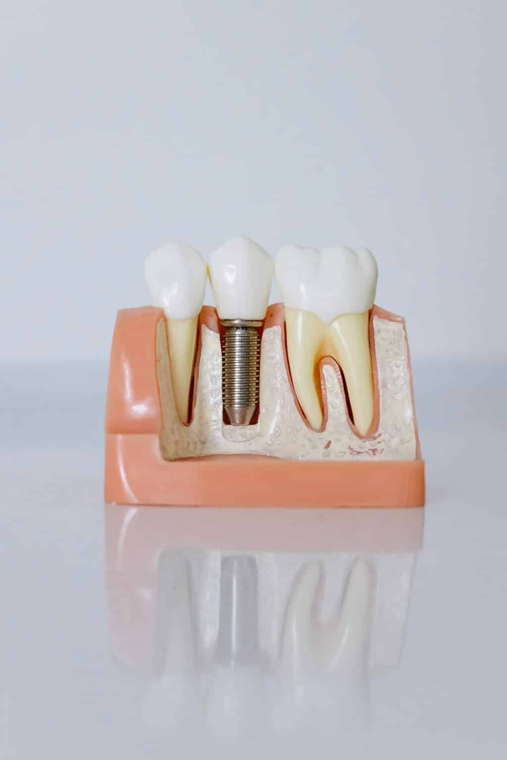 Implantes dentales Juslibol - Expertos en salud bucodental